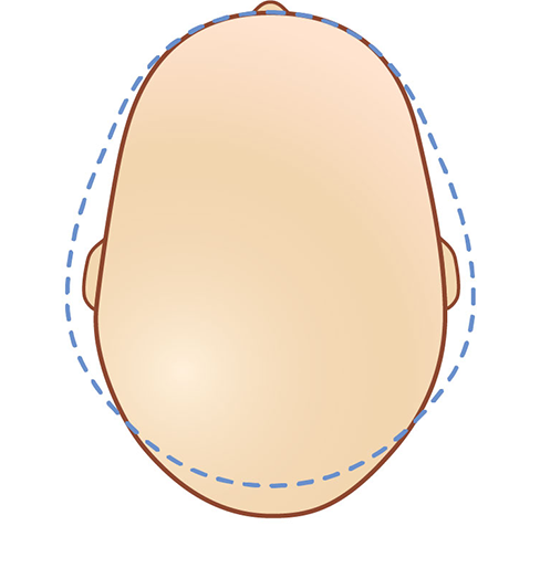 Cranial Helmets – Prosthetics & Orthotics Company USA