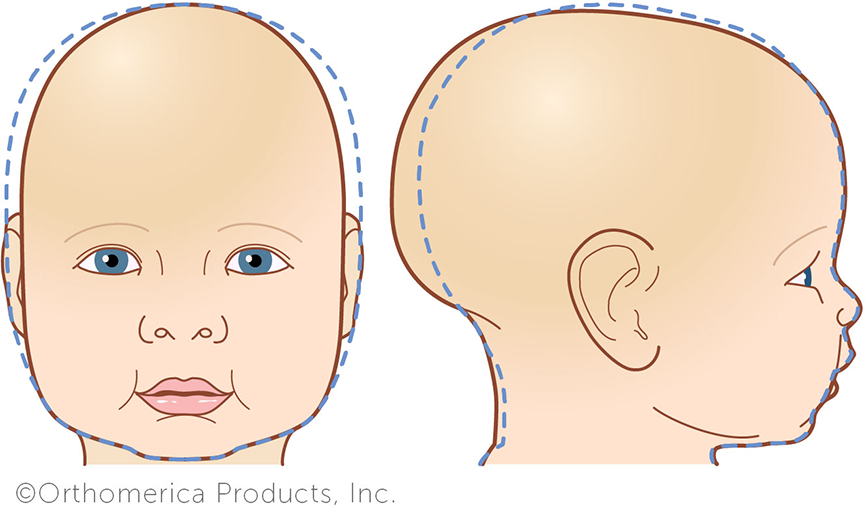 Cranial Helmets – Prosthetics & Orthotics Company USA