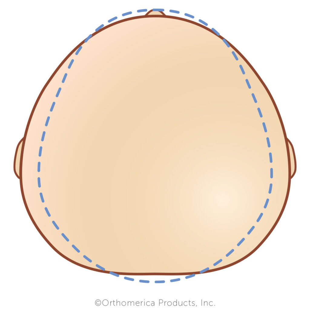 Cranial Helmets – Prosthetics & Orthotics Company USA